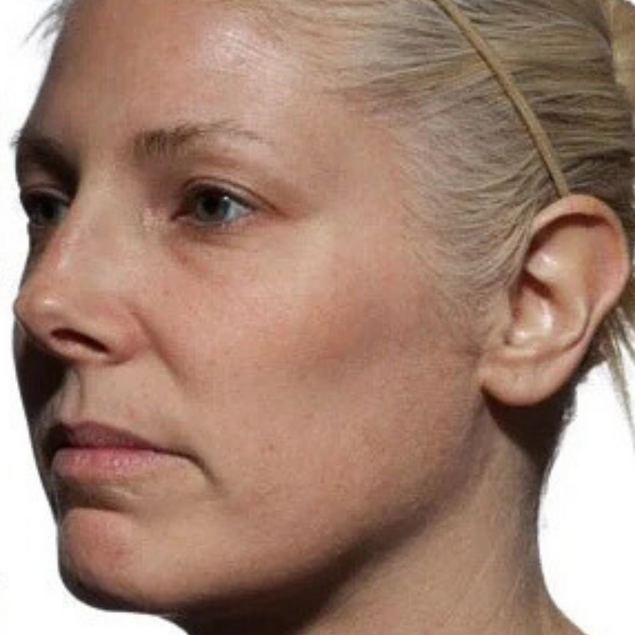 Skin Resurfacing Laser | Anti-Ageing Laser Treatment – Tria Laser Canada